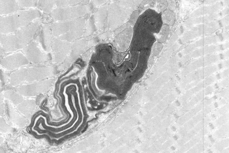 GNE myopathy - about our research - Lochmüller Lab